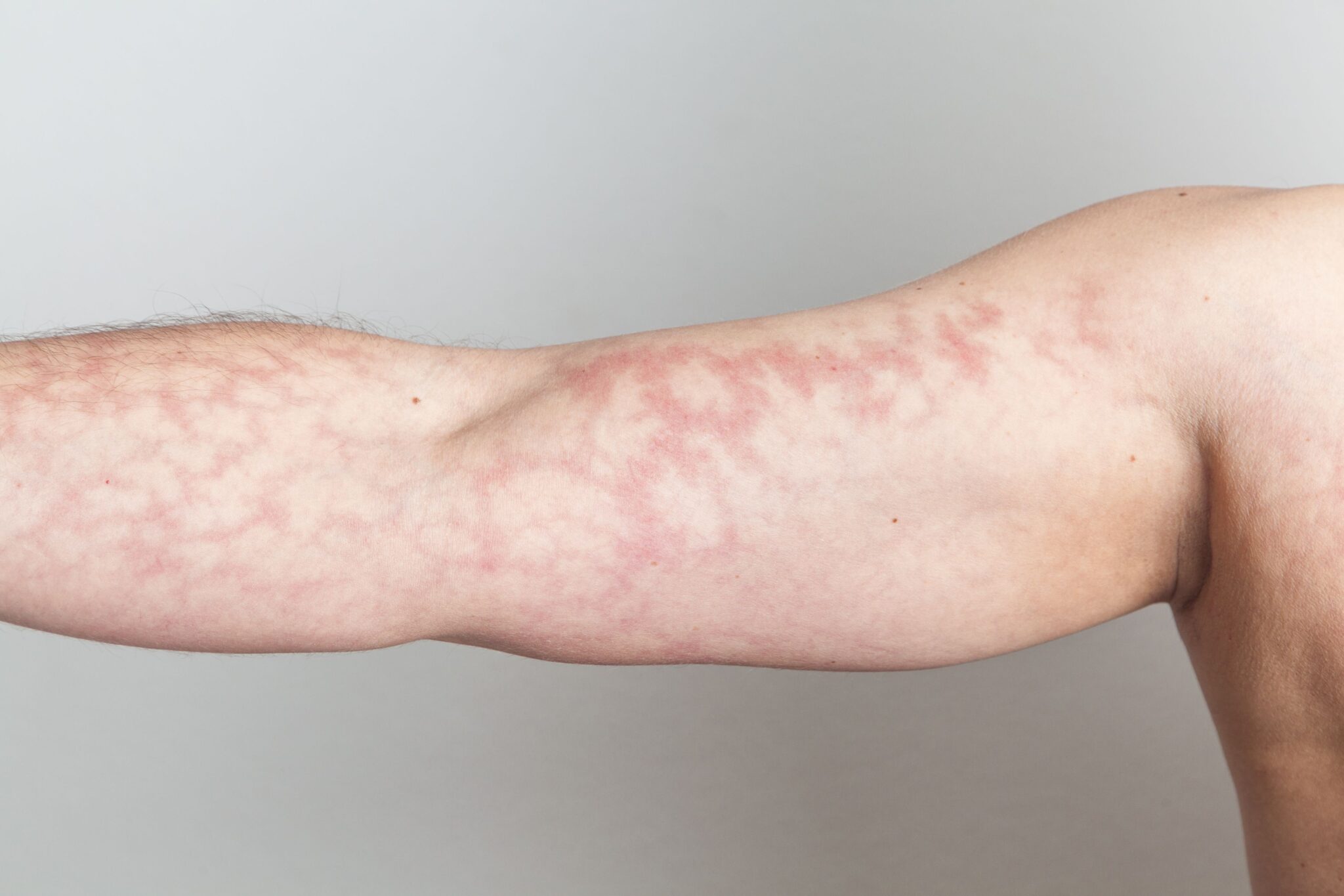 Levidia Symptoms - Molted Skin: Understanding and Managing
